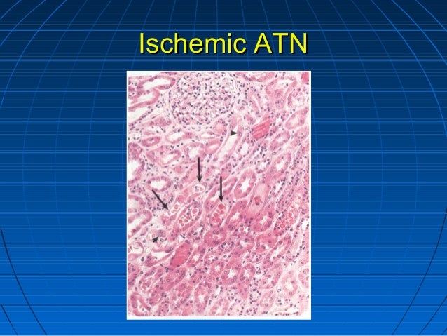 Acute tubular necrosis