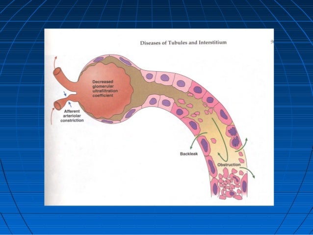 Acute tubular necrosis