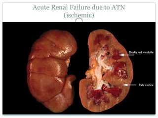 Acute Tubular Necrosis | PPTX