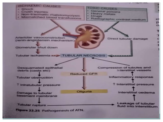 Acute Tubular Necrosis | PPTX