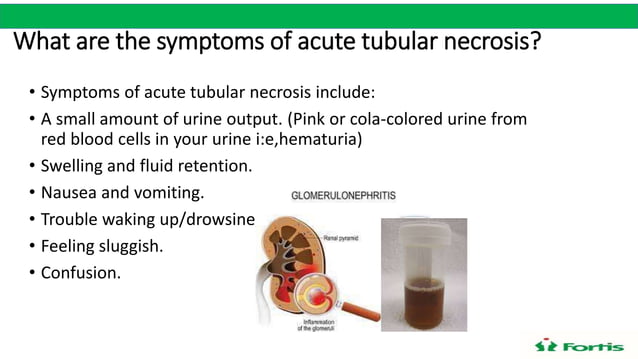 ACUTE TUBULAR NECROSIS.pptx | Lung and Respiratory Health | Diseases ...