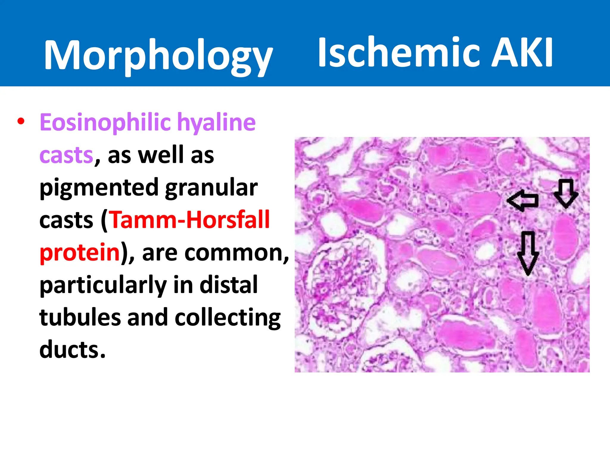 kidney pathology Acute tubular necrosis .pptx