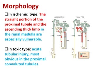 kidney pathology Acute tubular necrosis .pptx