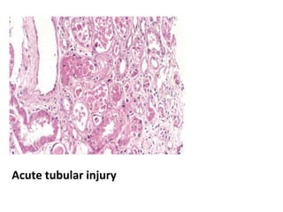 kidney pathology Acute tubular necrosis .pptx