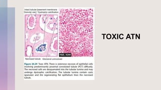 Acute Tubular Necrosis - Ischemic and Toxic ATN | PPTX