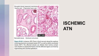 Acute Tubular Necrosis - Ischemic and Toxic ATN | PPTX