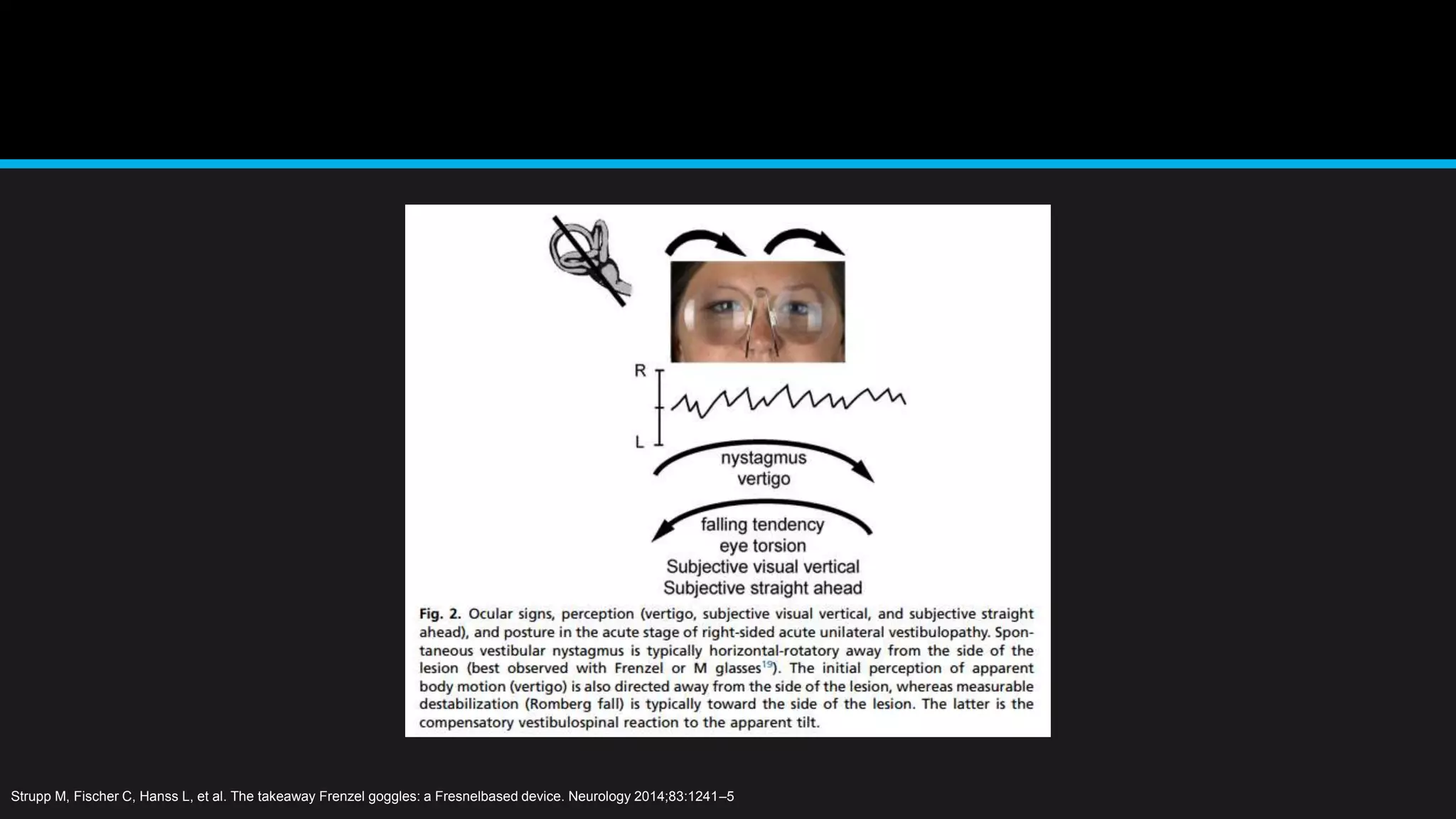 Acute Unilateral Vestibulopathy | PPTX