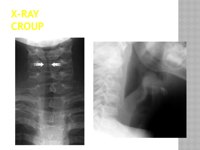 Acute upper airway obstruction is Blockage of any portion of the airway ...