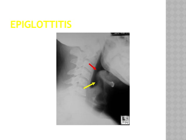 Acute upper airway obstruction is Blockage of any portion of the airway ...