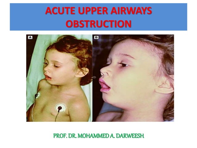 Acute upper airways obstruction 20-21.pptx