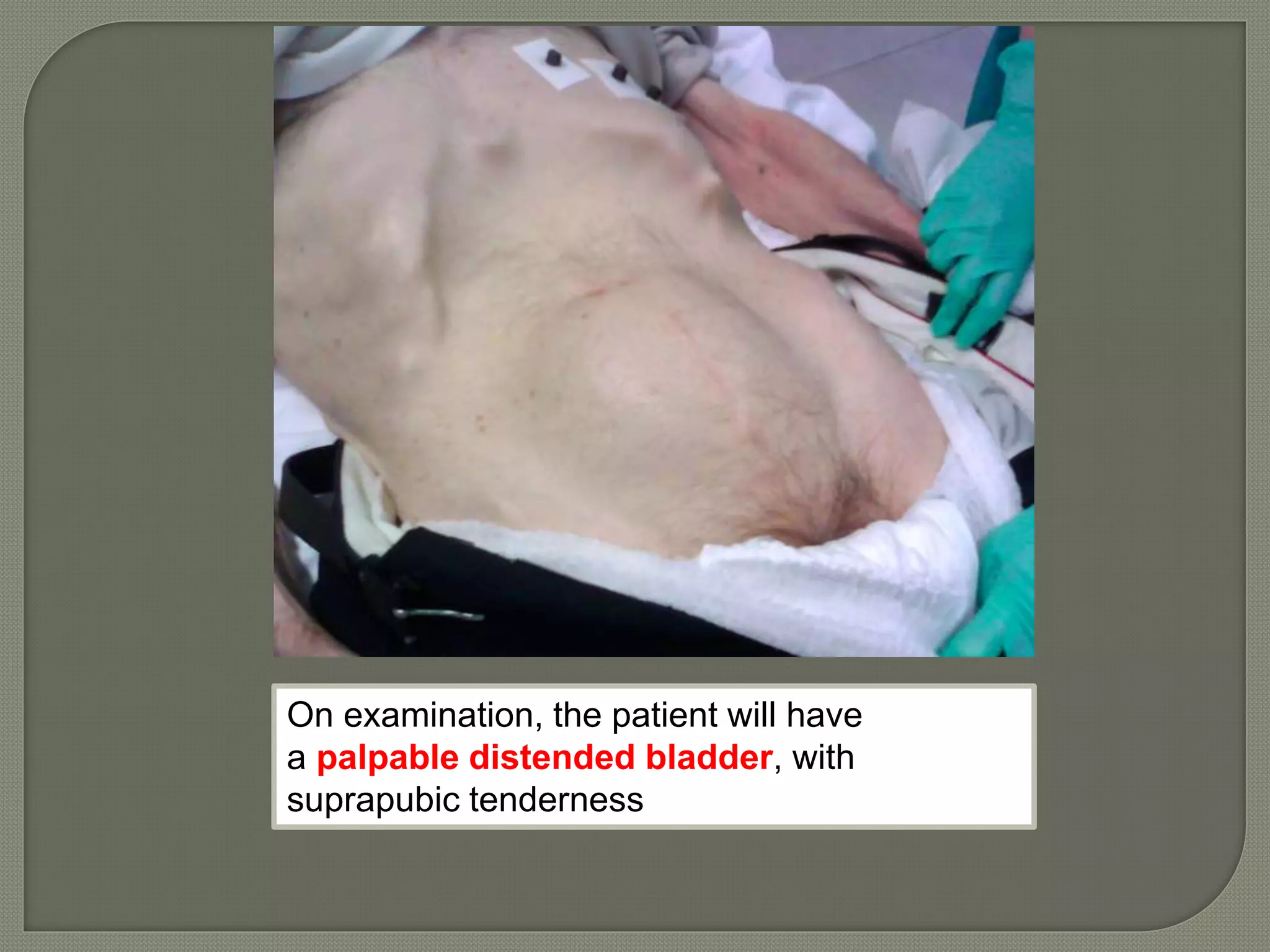 Acute Urinary Retention.pptx