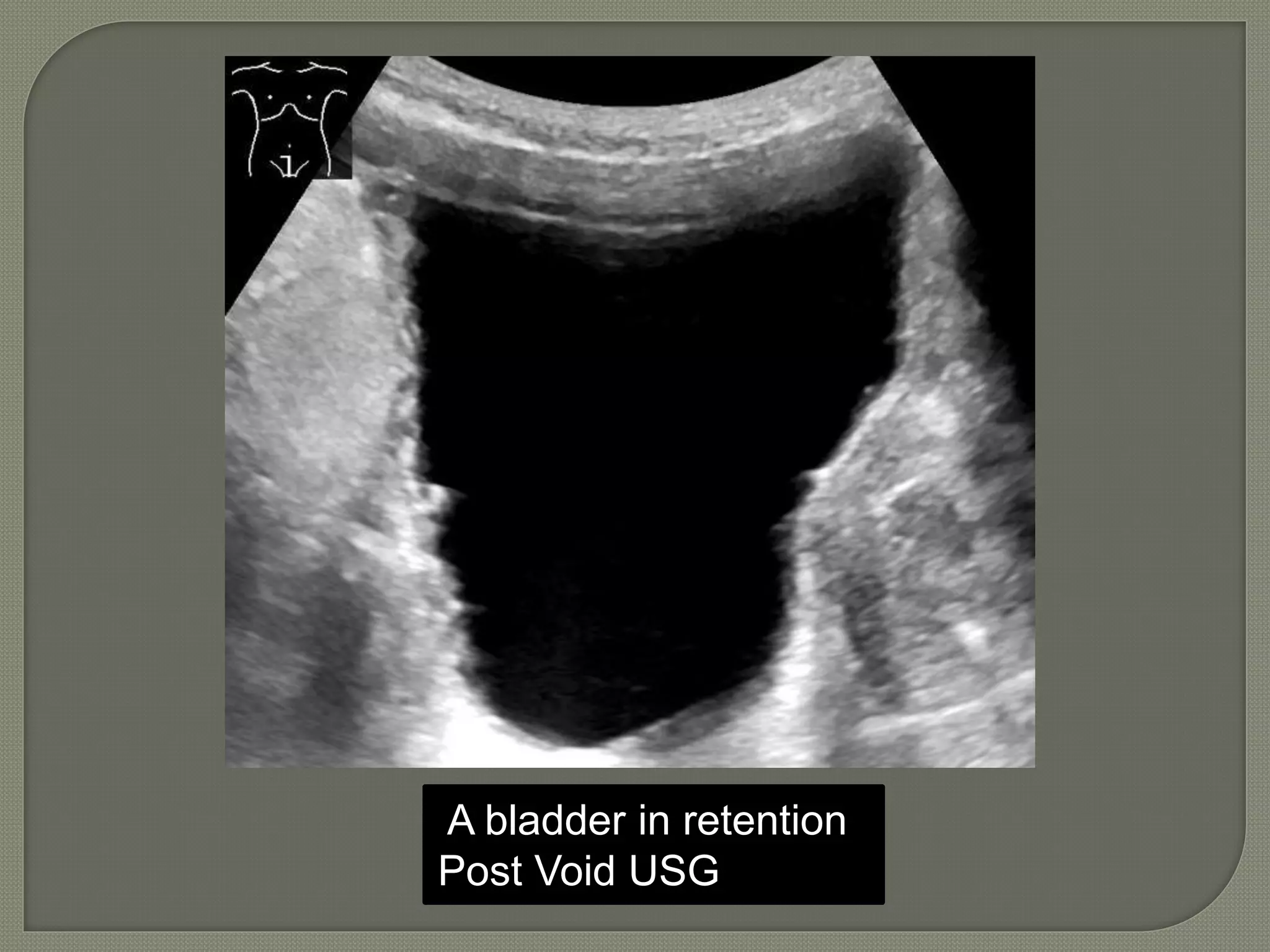 Acute Urinary Retention.pptx