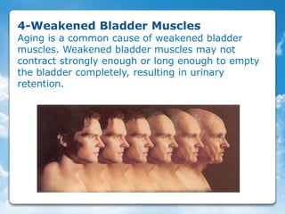 Acute urinary retintion | PPTX