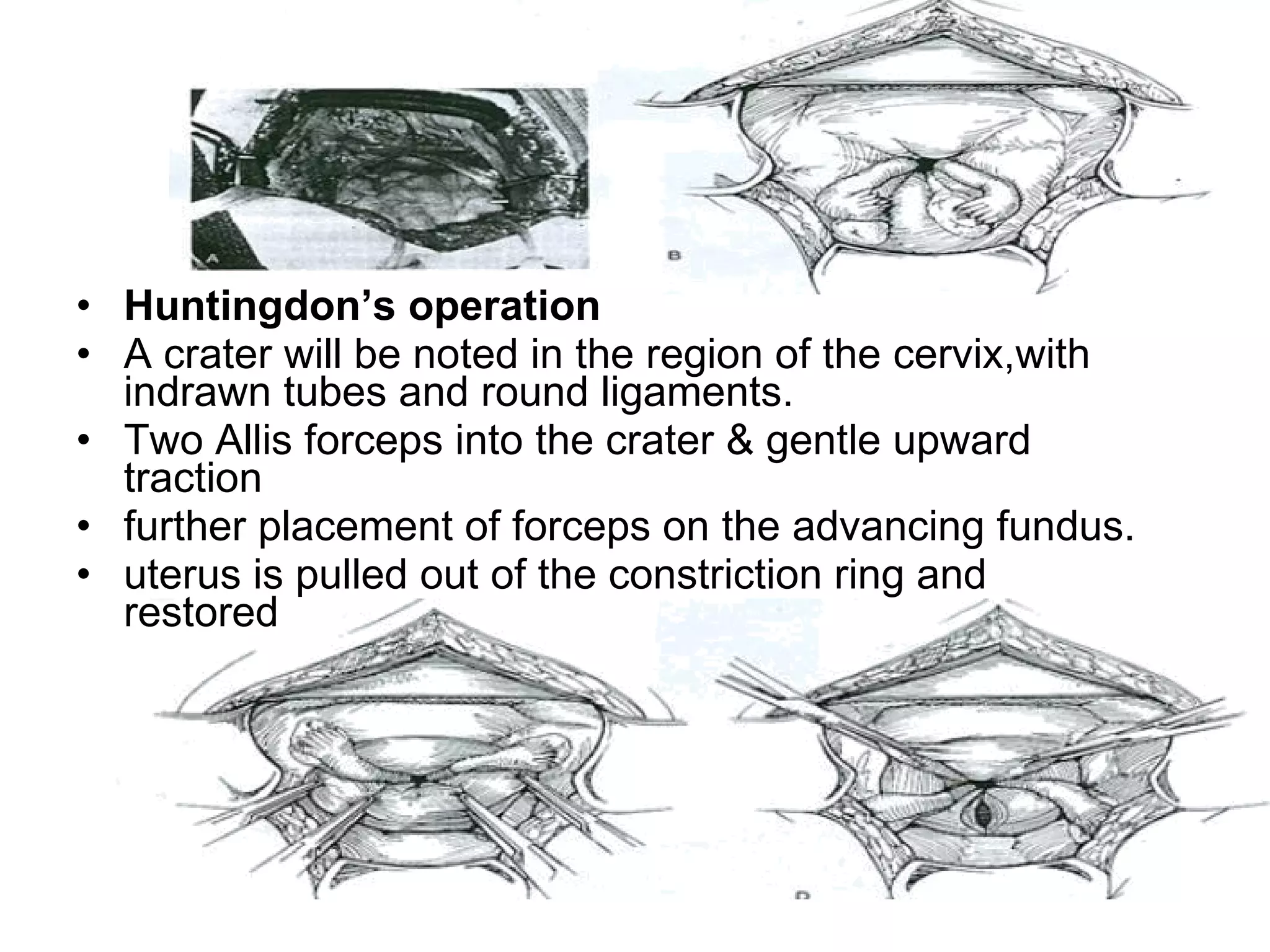 Acute uterine inversion | PPT