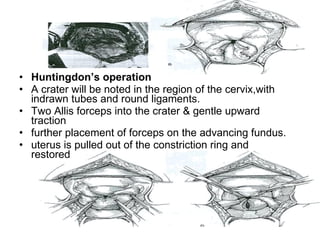 Acute uterine inversion | PPT