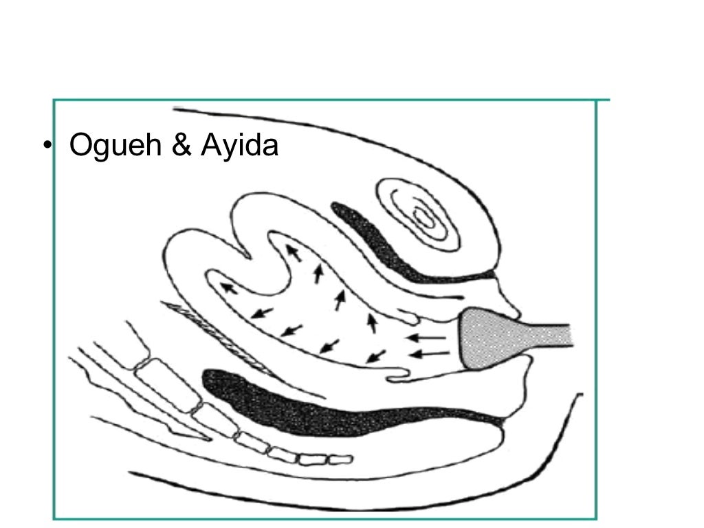 Acute uterine inversion