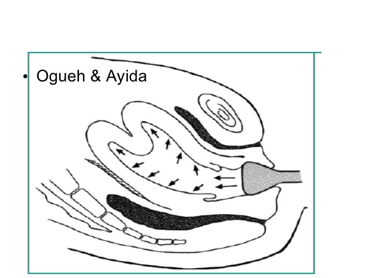 Acute uterine inversion