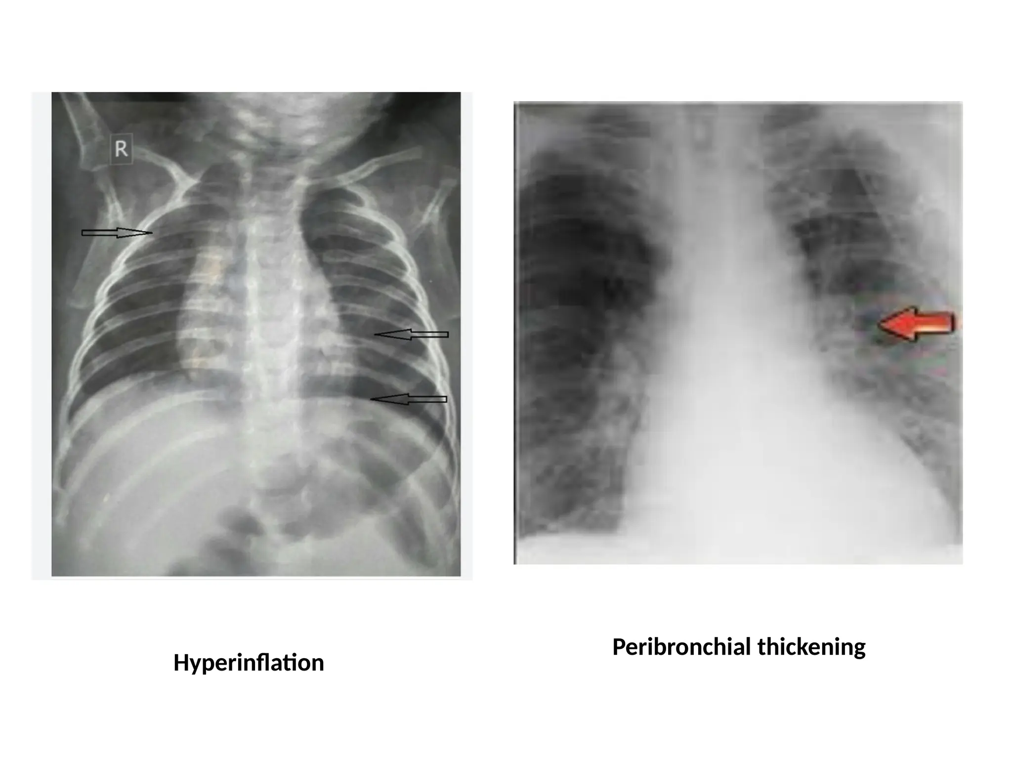 Acute Viral Bronchiolitis diagnosis & treatment.pptx