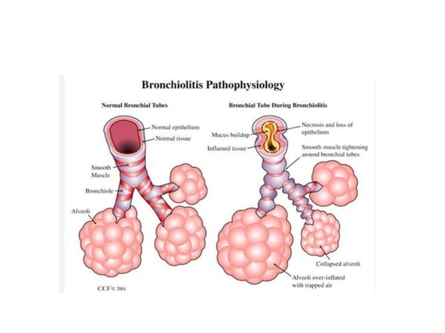Acute Viral Bronchiolitis diagnosis & treatment.pptx