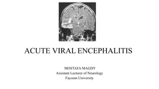 Acute viral encephalitis.pptx
