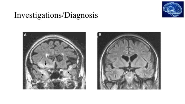 Acute viral encephalitis.pptx