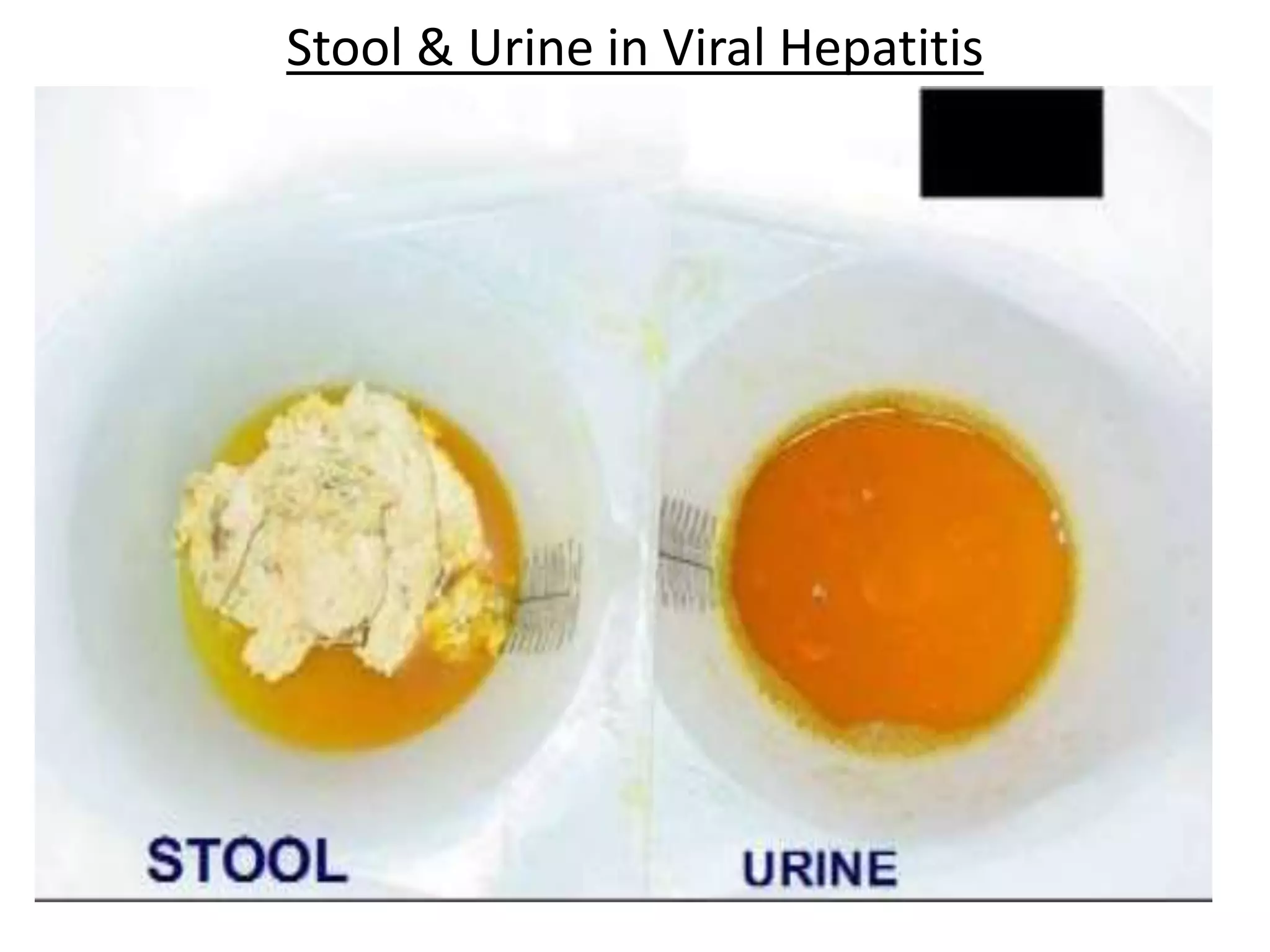 Acute viral hepatitis | PPTX