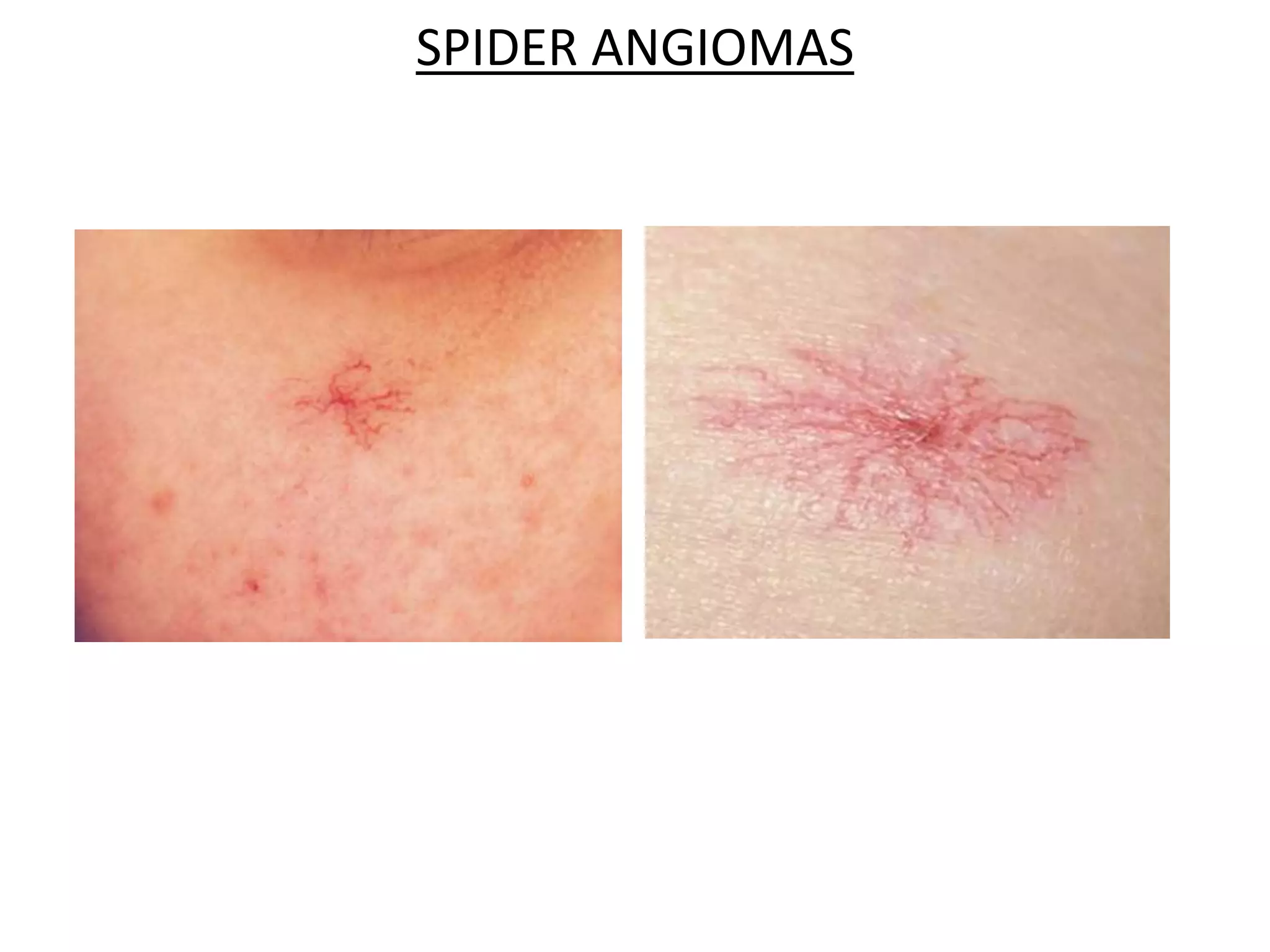 Acute viral hepatitis | PPTX