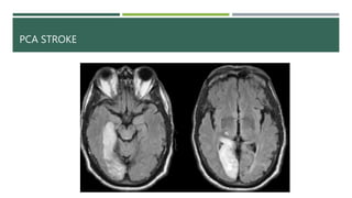 Acute loss of vision | PPTX