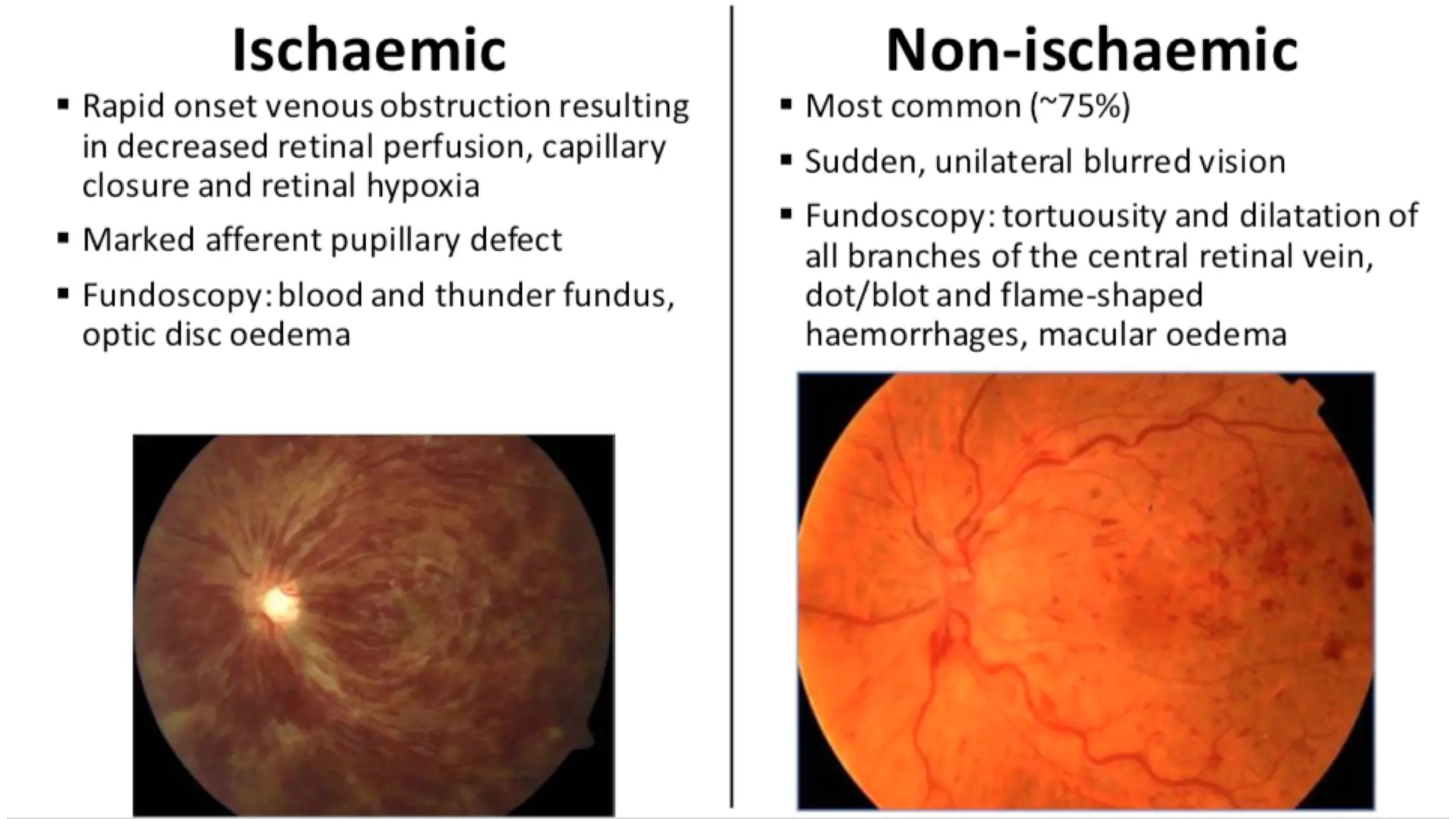 acute vision loss cme with case presentation 15022024 | PDF