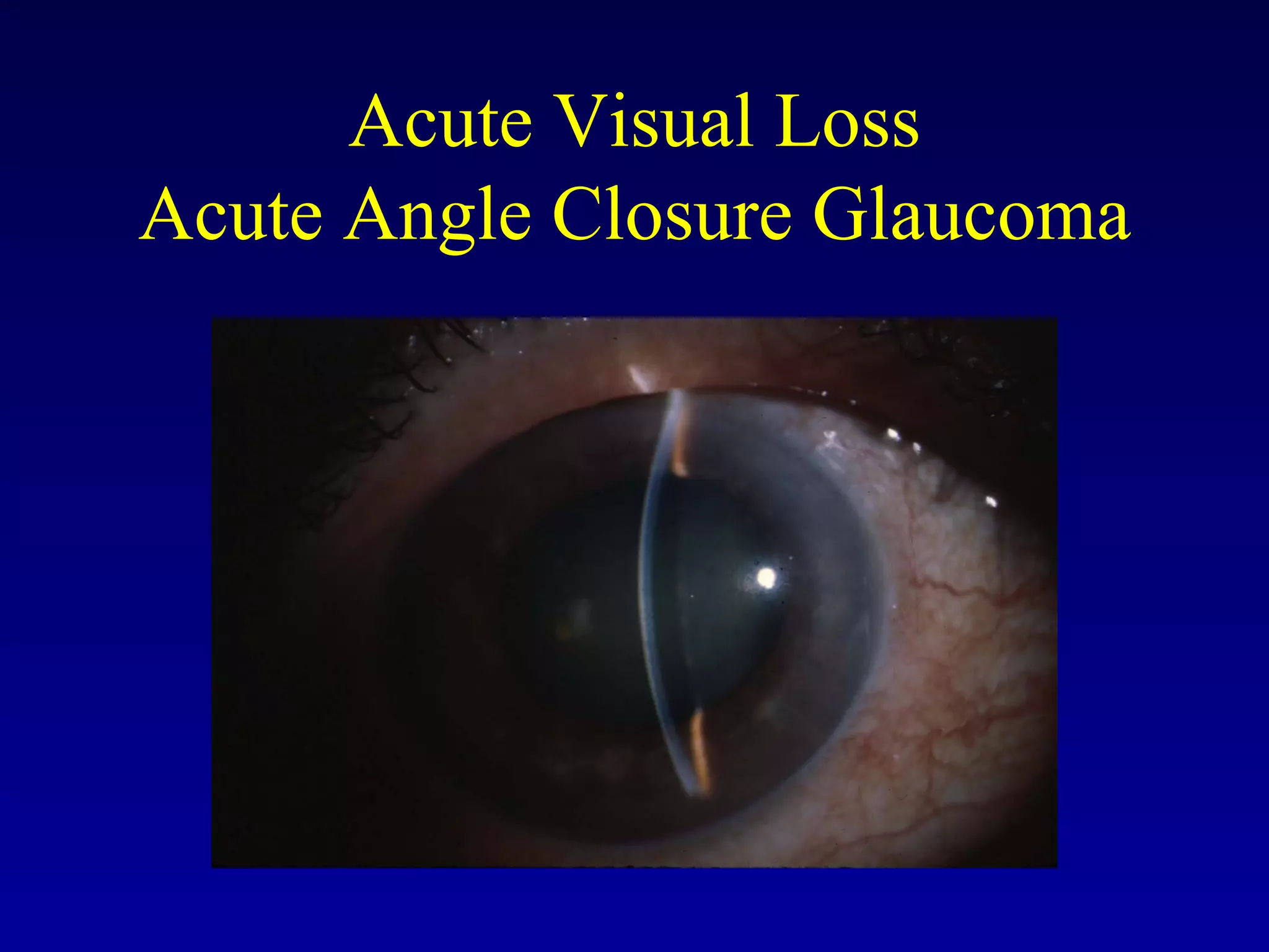 Acute visual loss | PDF