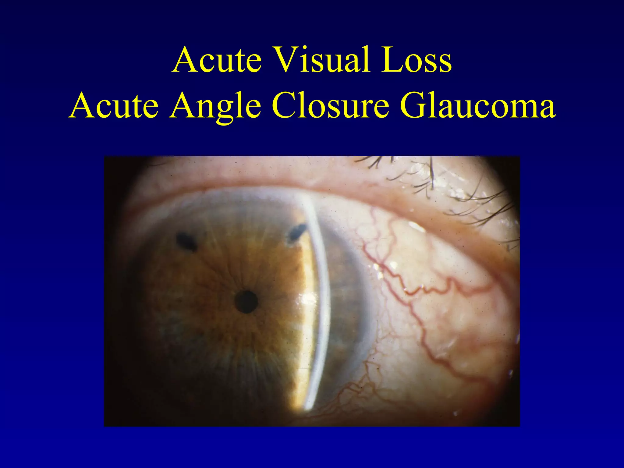 Acute visual loss | PDF