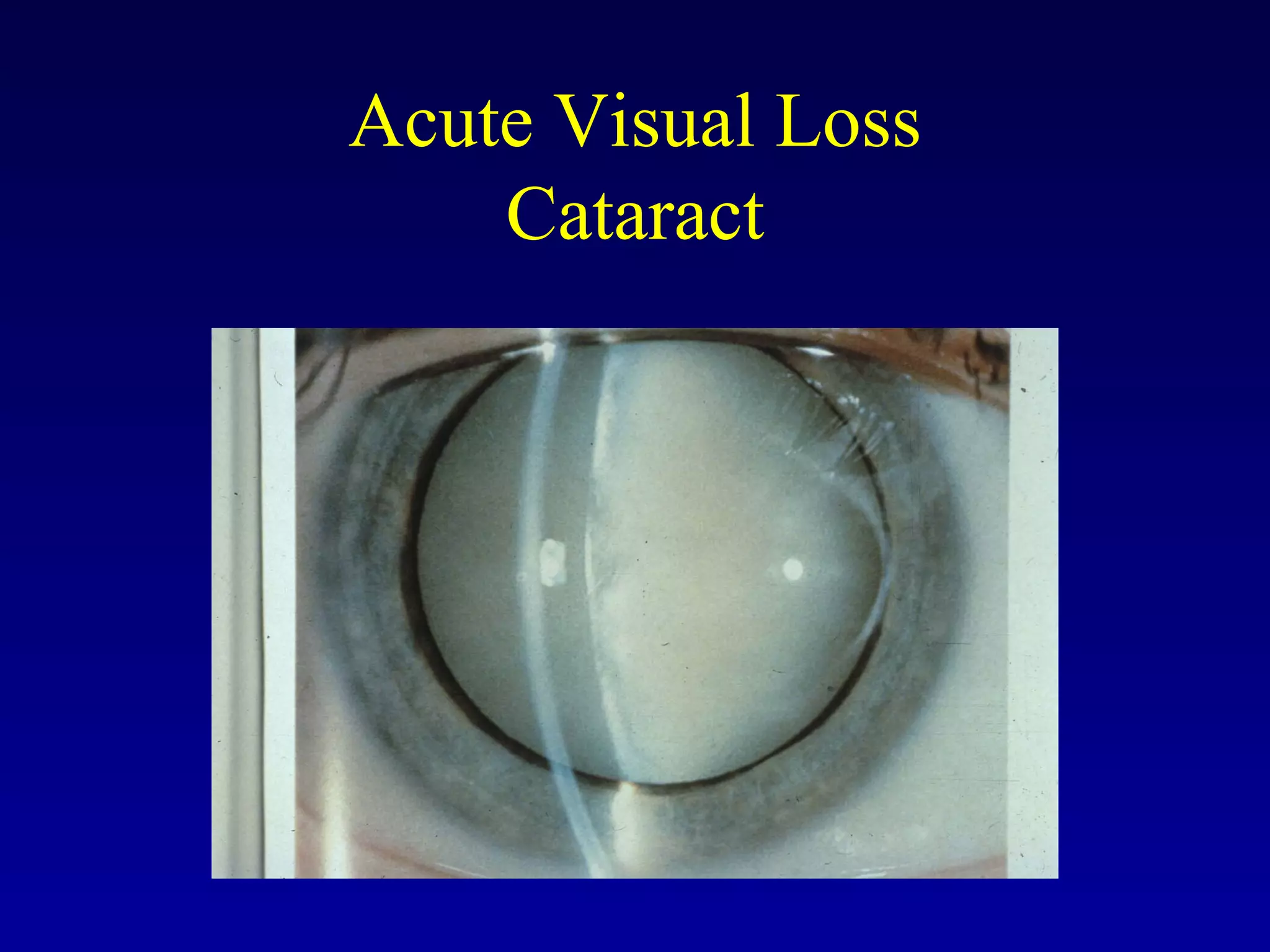 Acute visual loss | PDF