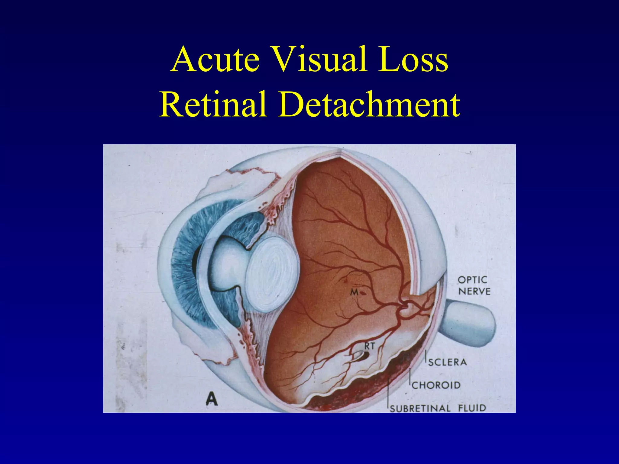 Acute visual loss | PDF