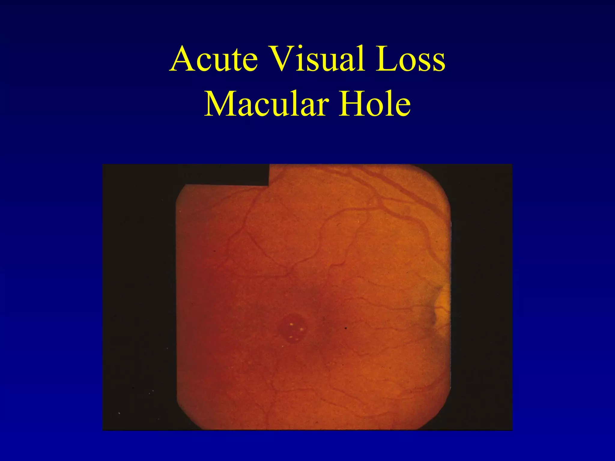 Acute visual loss | PDF