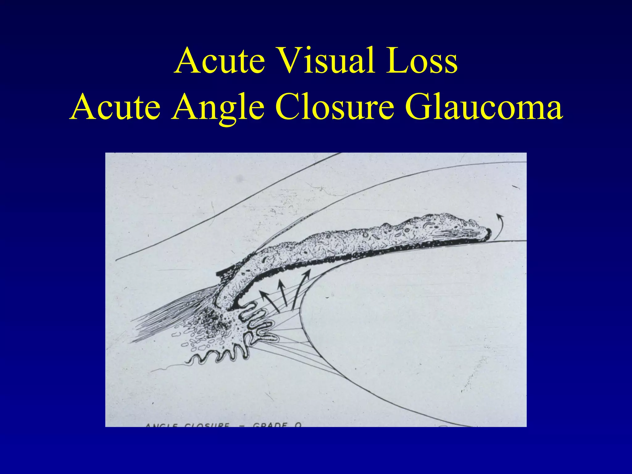 Acute visual loss | PDF