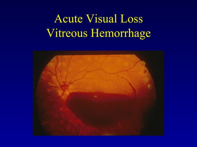 Acute visual loss | PDF
