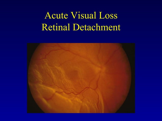 Acute visual loss | PDF