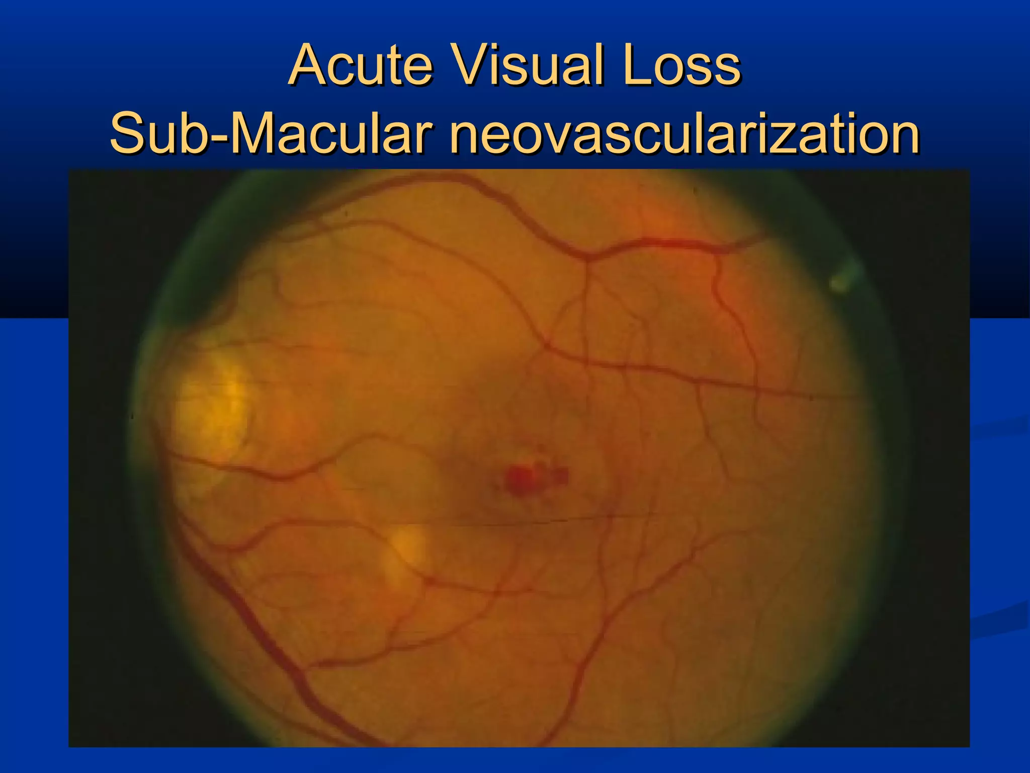 Acute visual loss | PPT