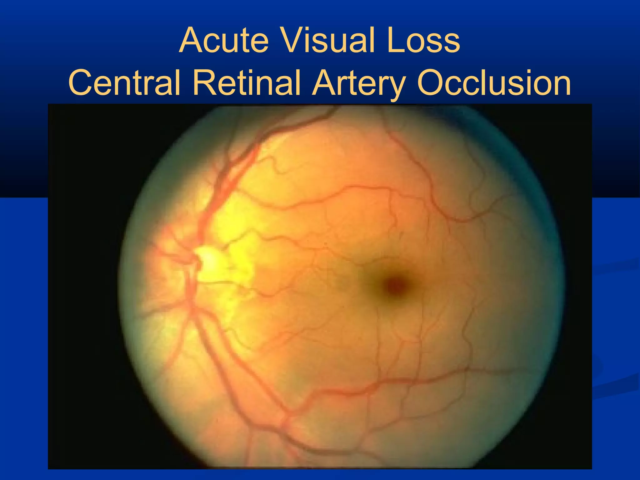 Acute visual loss | PPT