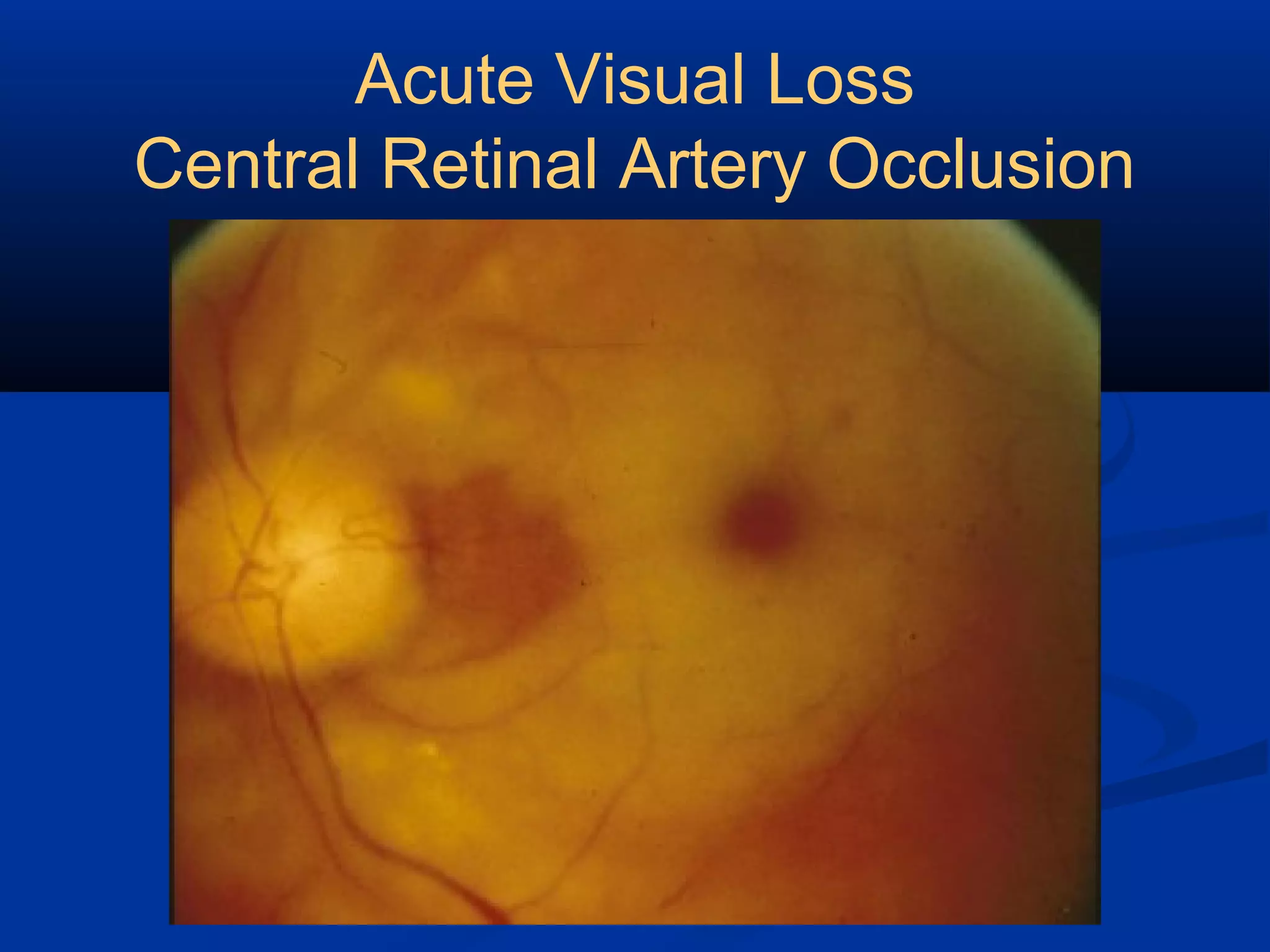 Acute visual loss | PPT