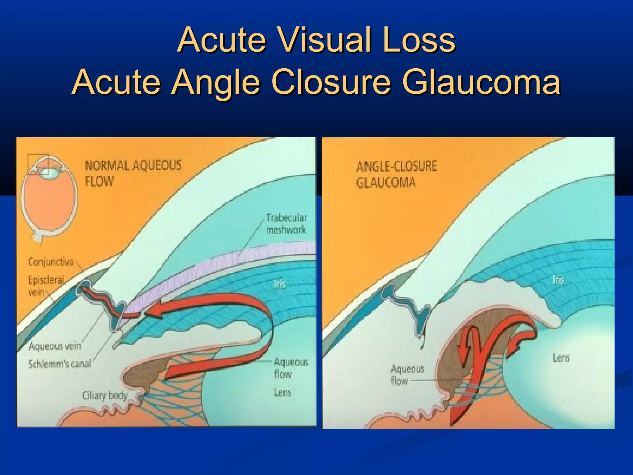 Acute visual loss | PPT