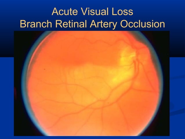 Acute visual loss | PPT | Eye and Vision Conditions | Diseases and ...
