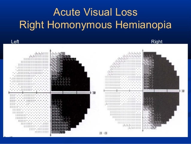 Acute visual loss