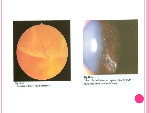 Acute Visual Loss | PPT | Eye and Vision Conditions | Diseases and ...