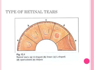 Acute Visual Loss | PPT
