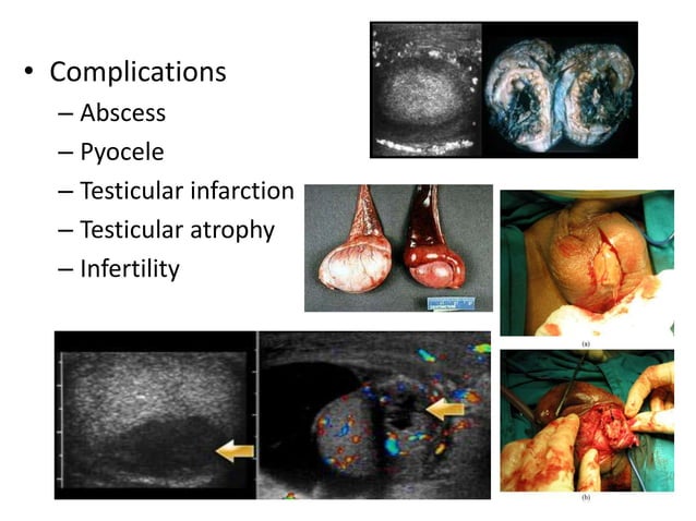 Acute vs chronic scrotal swelling | PPTX | Infertility | Reproductive Health