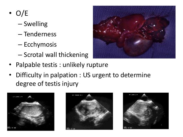 Acute Vs Chronic Scrotal Swelling