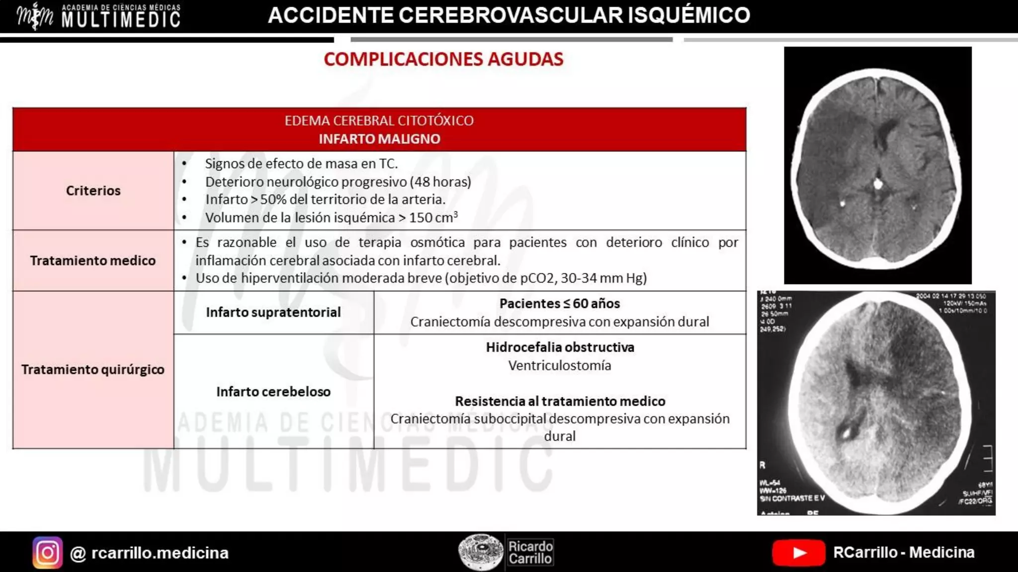 Acv neurocirugia | PPT