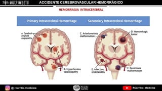 Acv neurocirugia | PPT