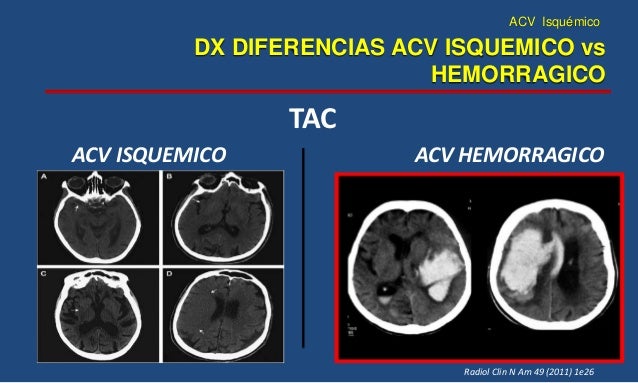 Acv y-crisis-hipertensiva-mae